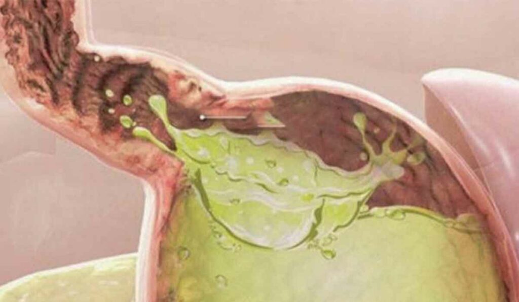 Medicii atentioneaza: Este deseori confundat cu refluxul ...